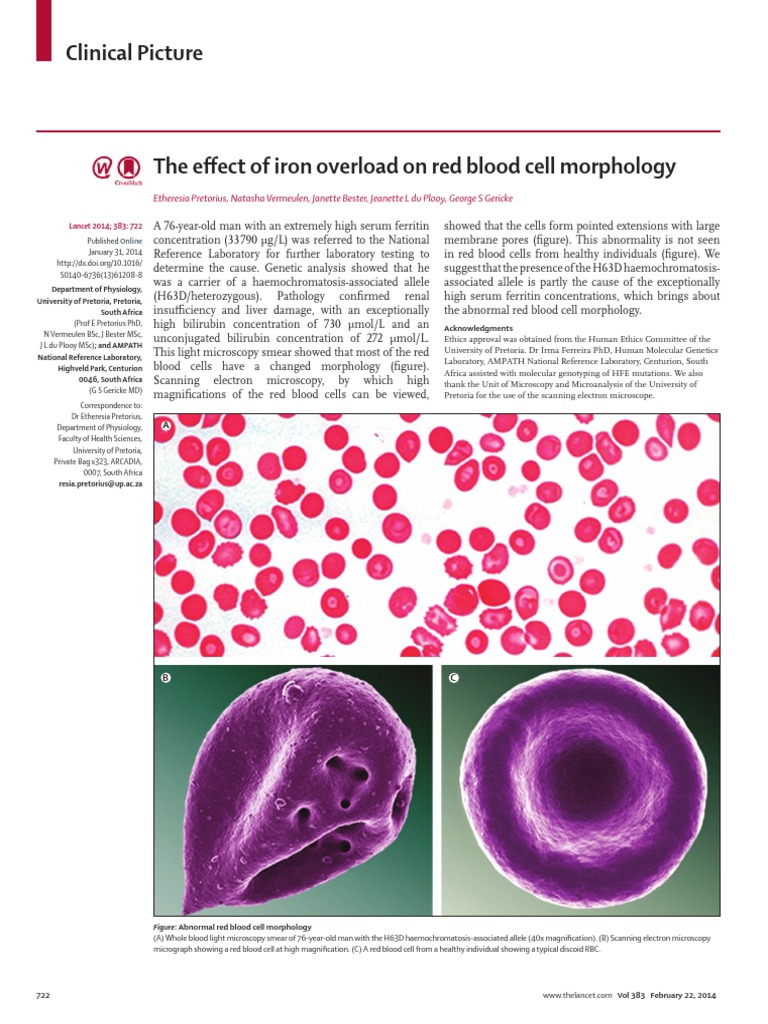 The Eff Ect of Iron Overload On Red Blood Cell Morphology | PDF | Red ...