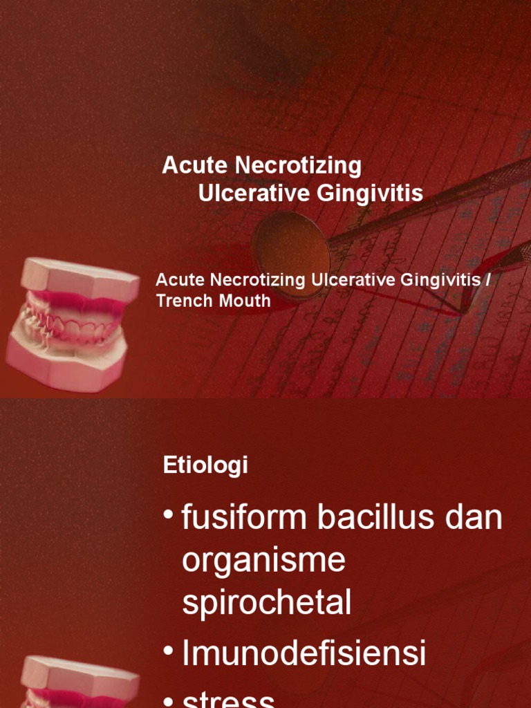 Acute Necrotizing Ulcerative Gingivitis