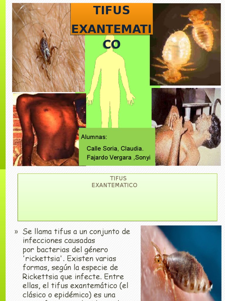 Tifus Exantematico | Salud pública | Enfermedades y trastornos