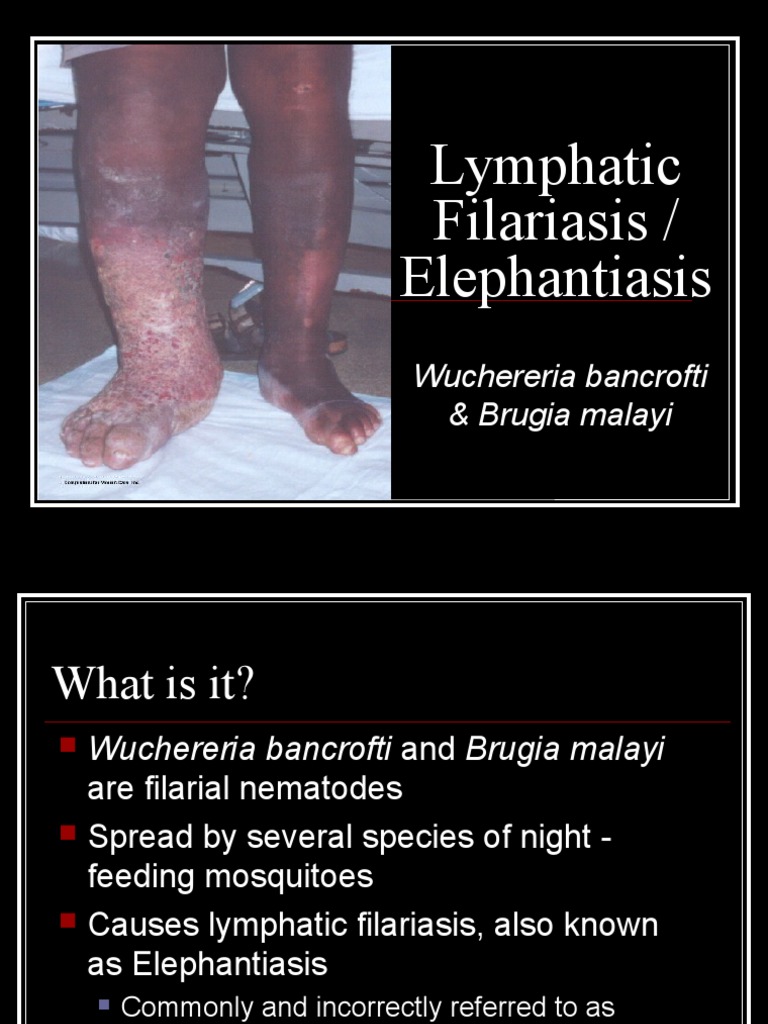 Lymphatic Filariasis / Elephantiasis: Wuchereria Bancrofti & Brugia ...
