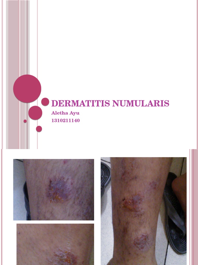 Dermatitis Numularis | PDF