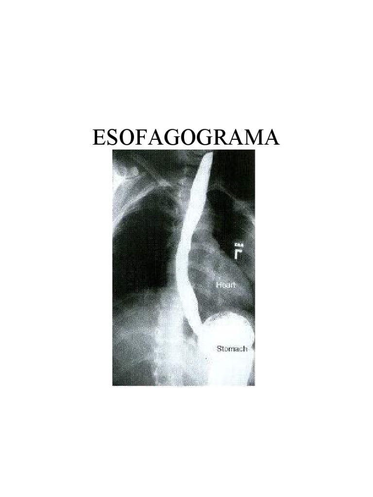Esofagograma | PDF