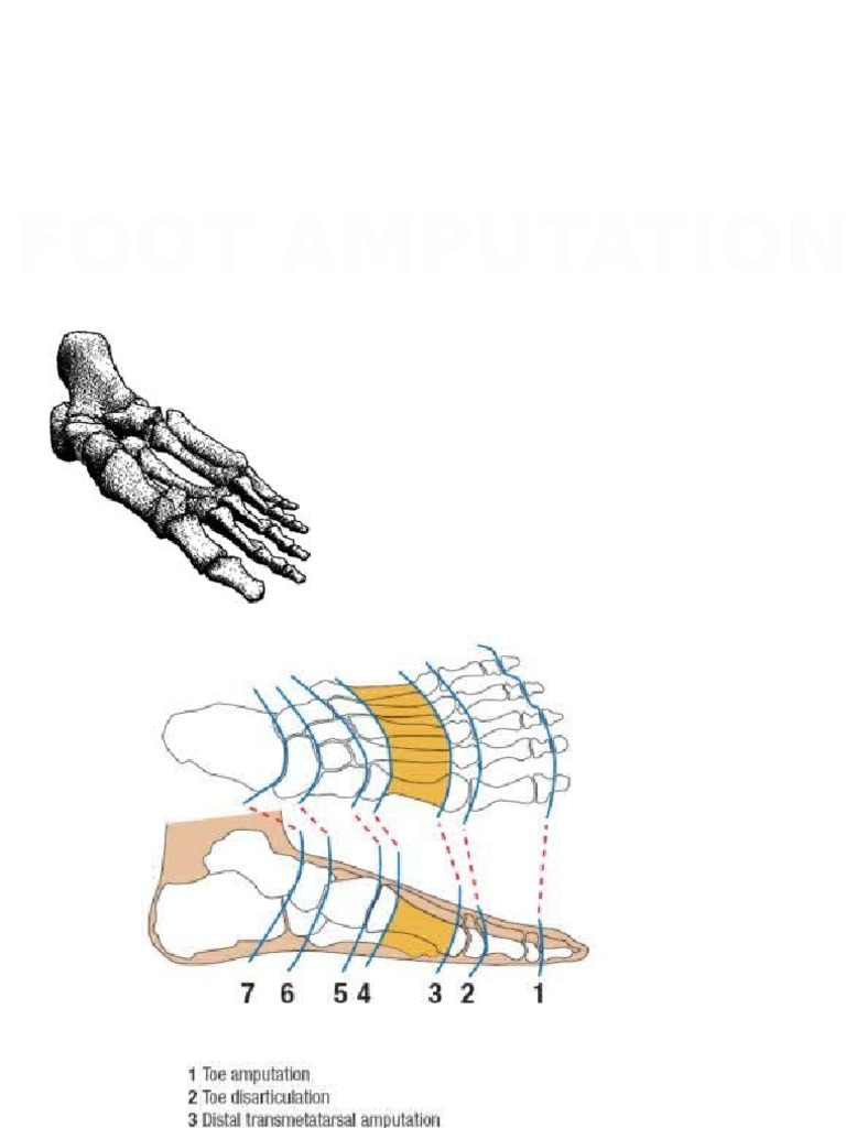 Foot Amputation | Foot | Ankle