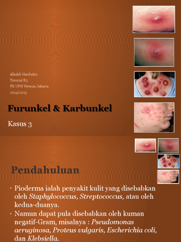 Furunkel & Karbunkel | PDF