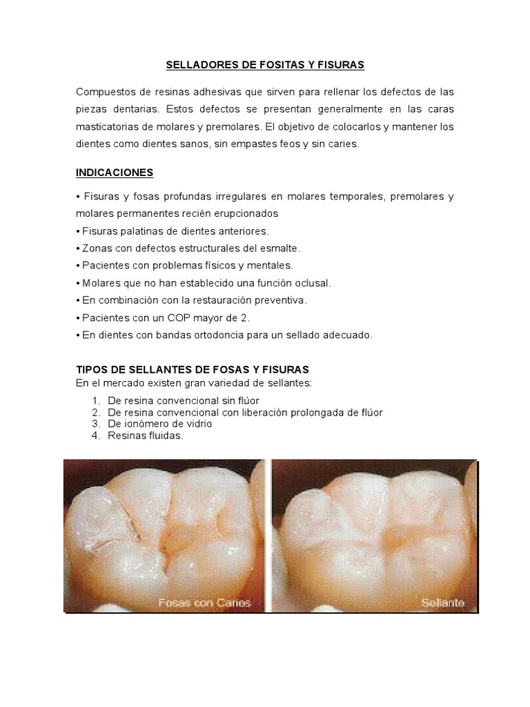 Selladores de Fosas y Fisuras Dentales | PDF | Diente humano ...