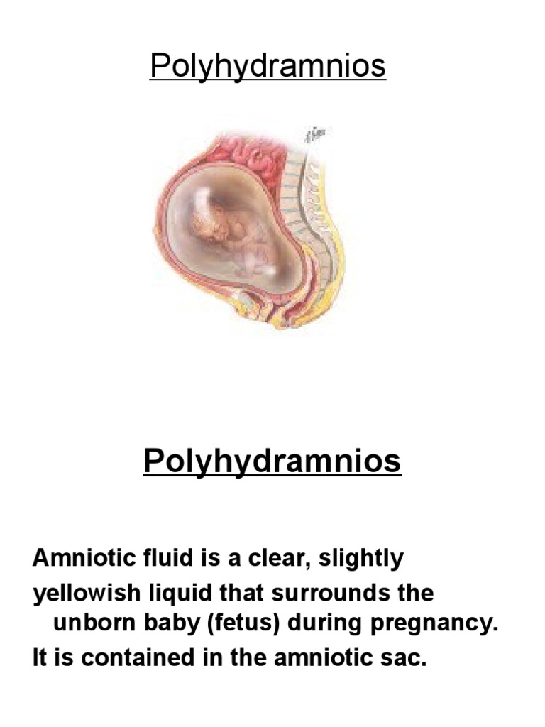 Over Distension of Uterus POLYHYDRAMNIOS