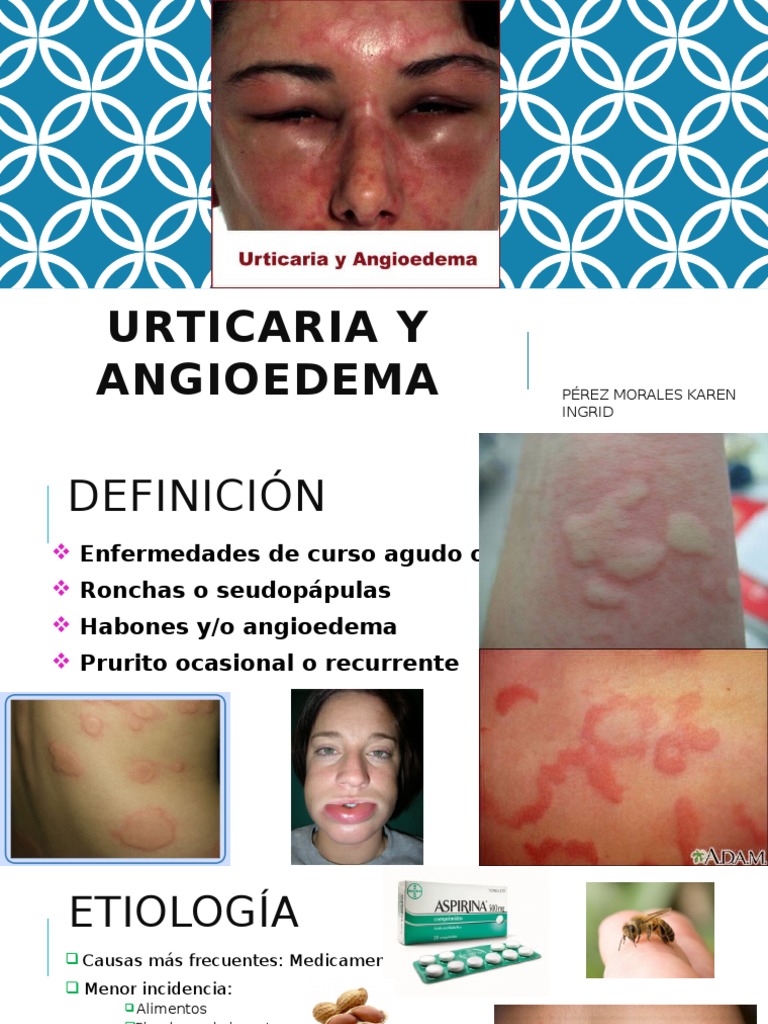 Urticaria y Angioedema | PDF | Condiciones cutáneas | Rtt