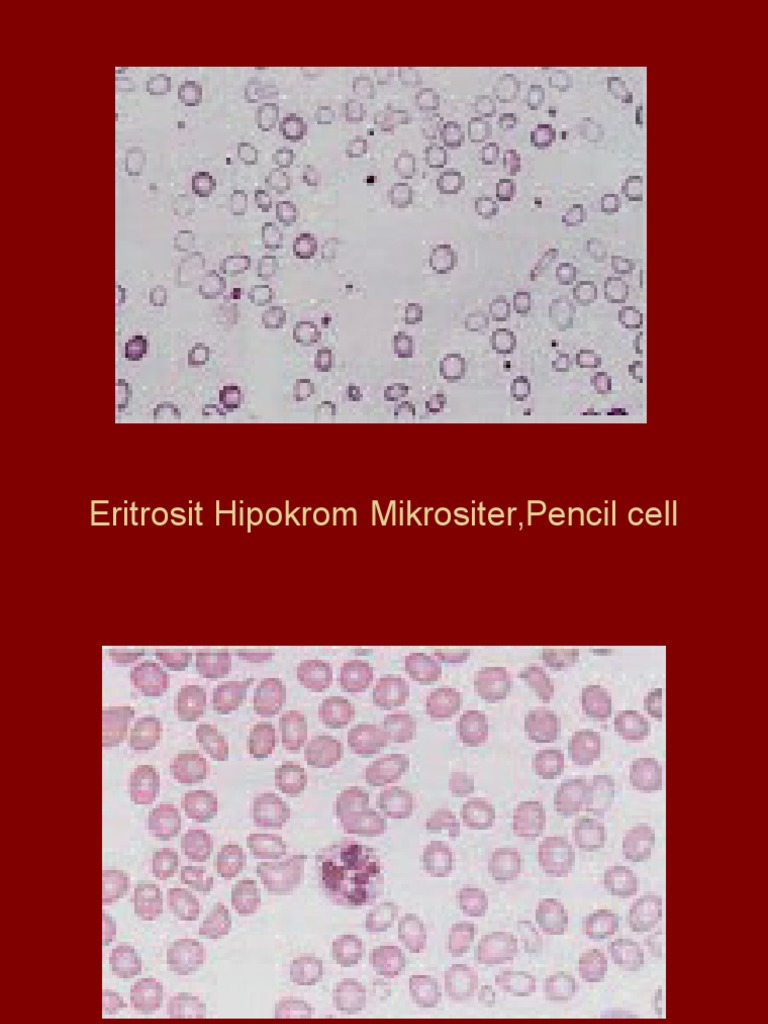 Eritrosit Hipokrom Mikrositer, Pencil Cell | PDF