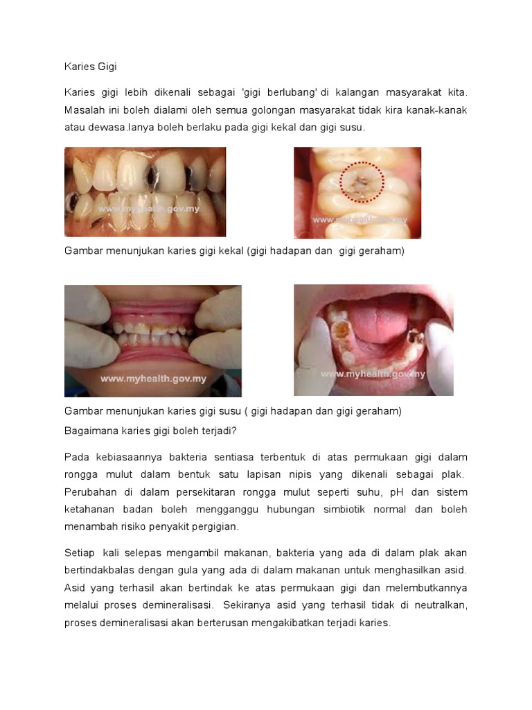 Karies Gigi | PDF