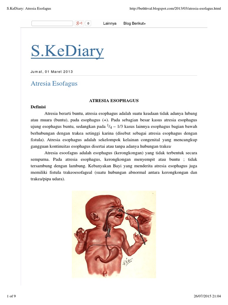 Atresia Esofagus | PDF