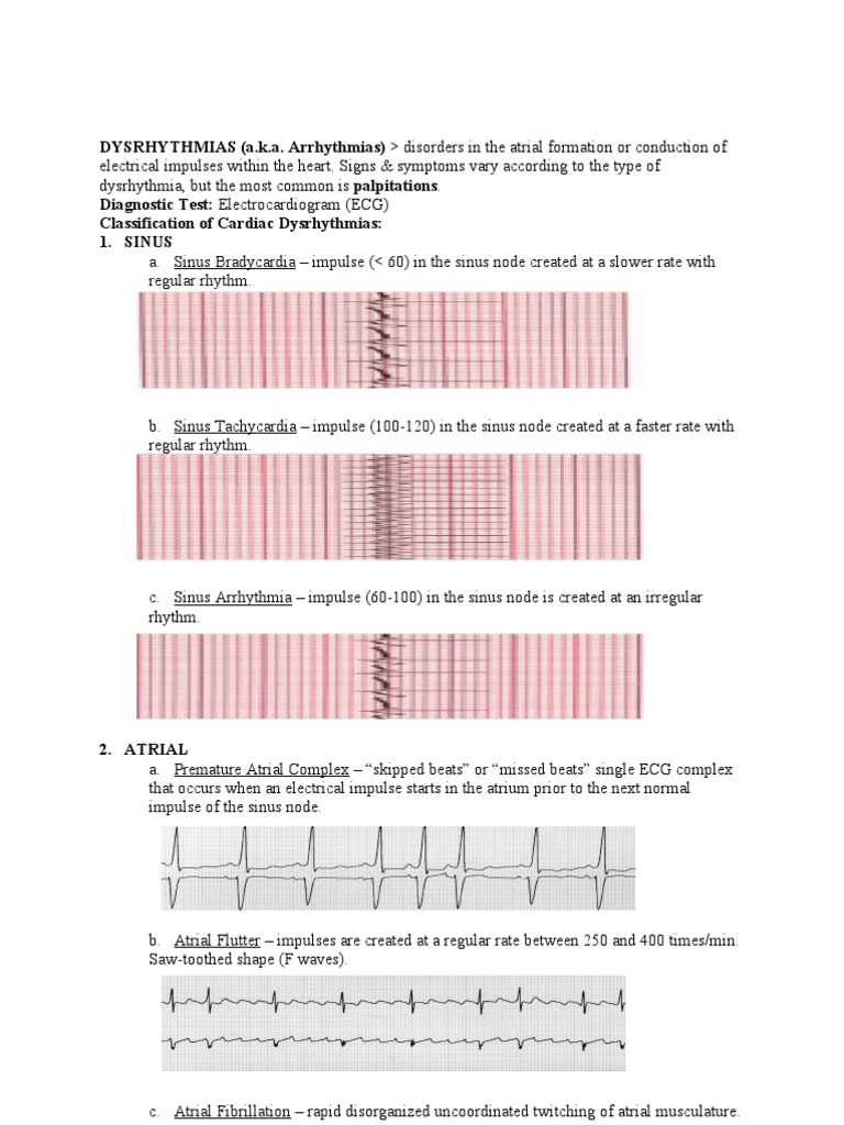 DYSRHYTHMIAS (A.k.a. Arrhythmias) Disorders in The | PDF | Cardiac ...