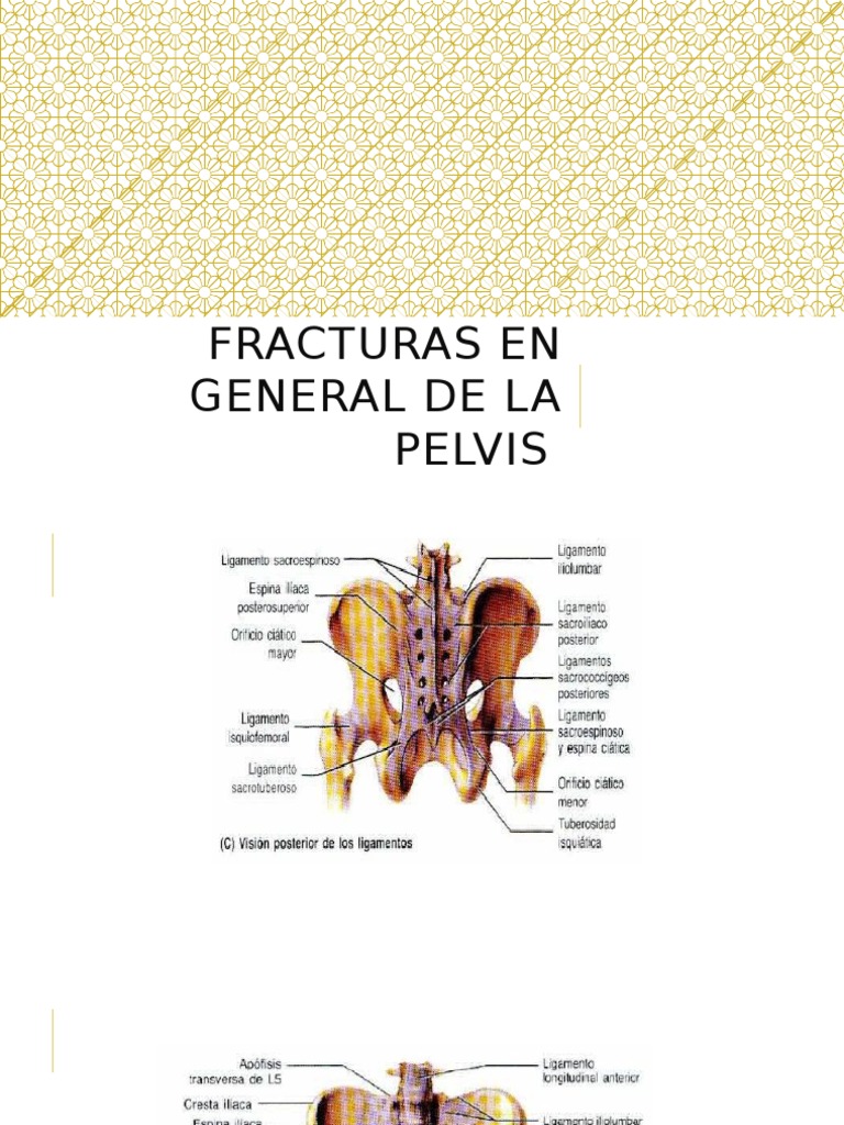 Fractura de Pelvis | PDF | Pelvis | Enfermedades y trastornos