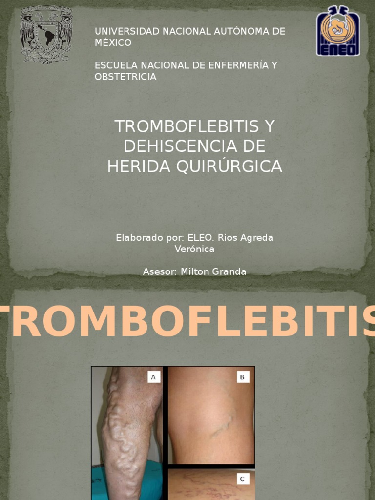 Tromboflebitis y Dehiscencia Quirúrgica | PDF | Trombo | Ciencias de la ...