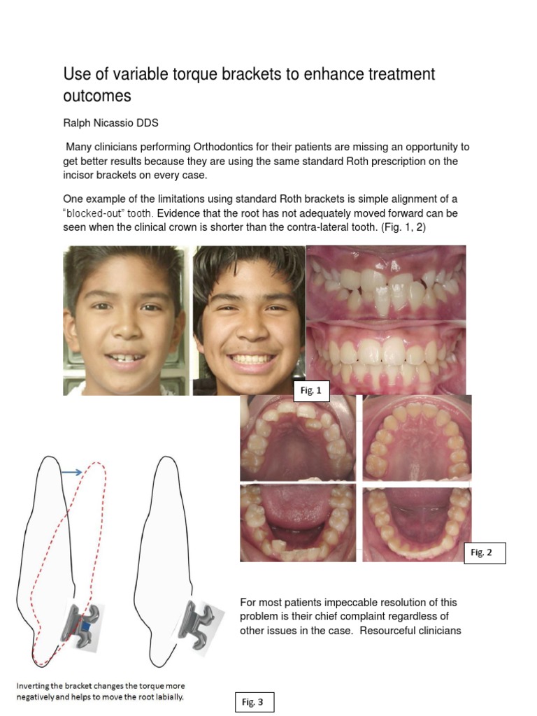 Variable Torque Brackets in Orthodontics | PDF | Orthodontics | Mouth