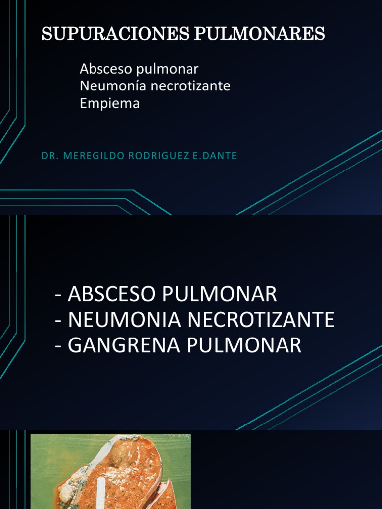 Supuraciones Pulmonares: Diagnóstico y Tratamiento | PDF | Neumonía ...