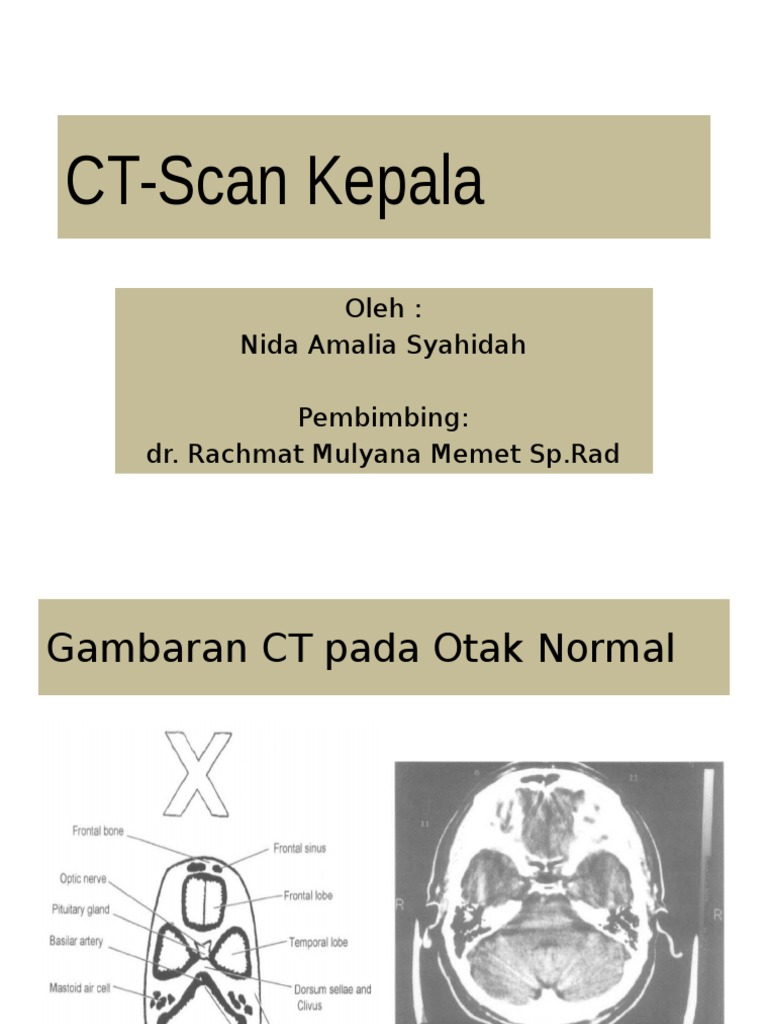 Gambaran CT Scan Kepala Normal dan Beberapa Kelainan Cerebrovaskuler | PDF