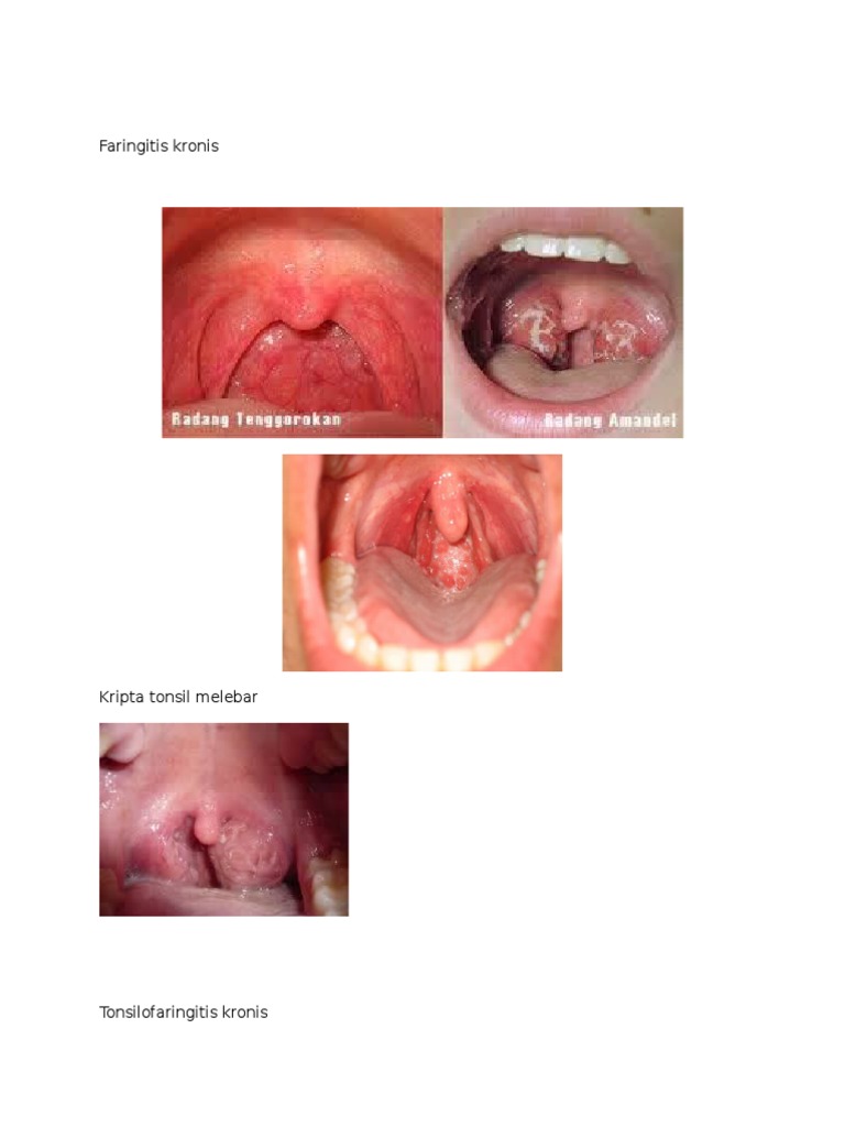 Faringitis Kronis | PDF