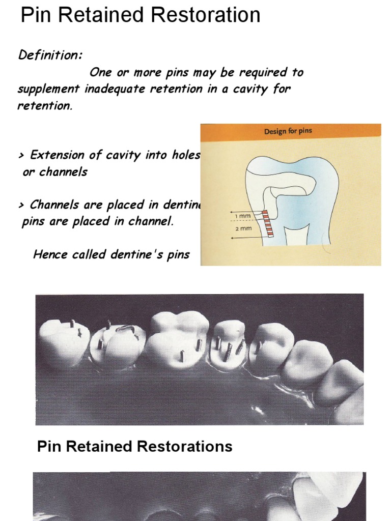 Pin Retained Restoration Techniques | PDF | Dentin | Tooth