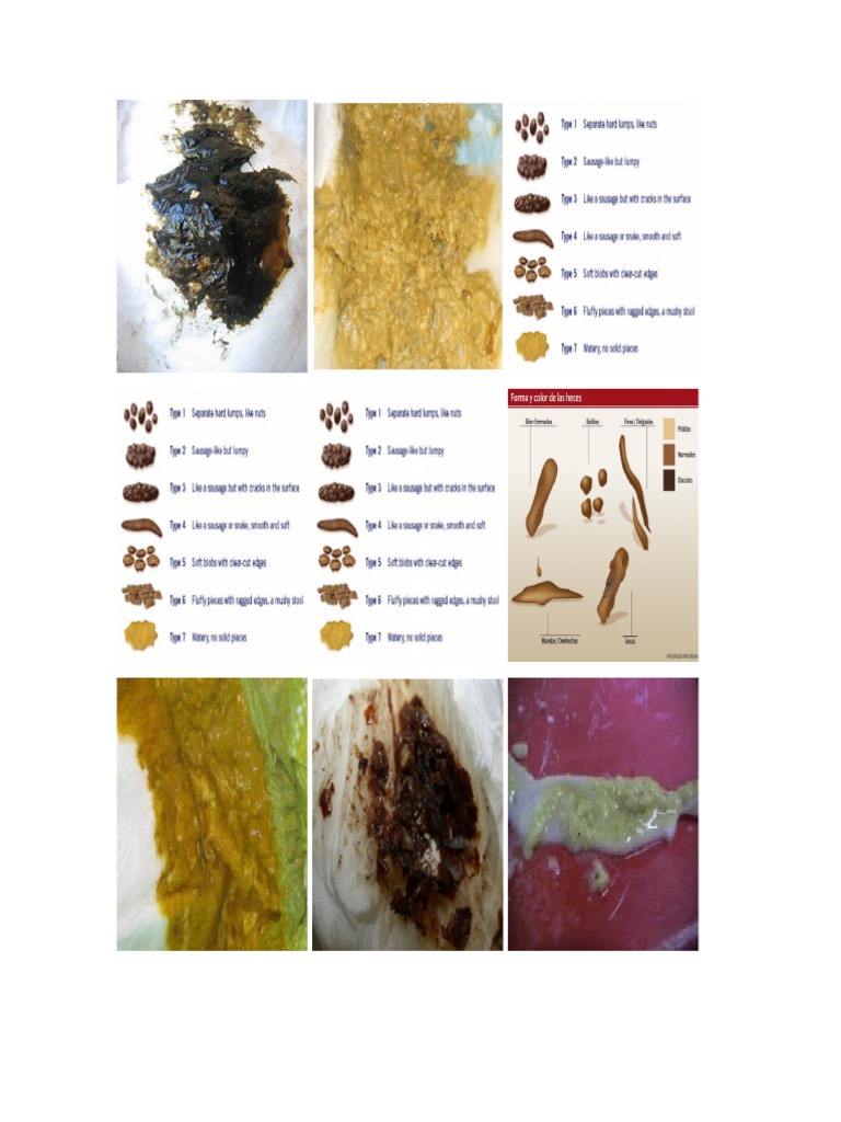 Imagenes de Heces | PDF