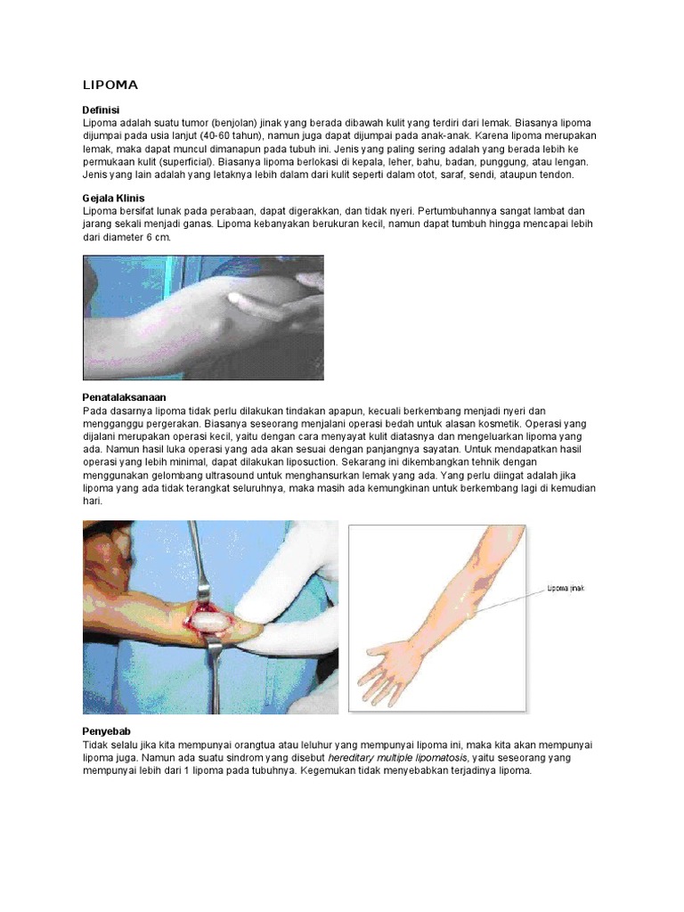 Penanganan dan Karakteristik Lipoma | PDF | Gaya Hidup