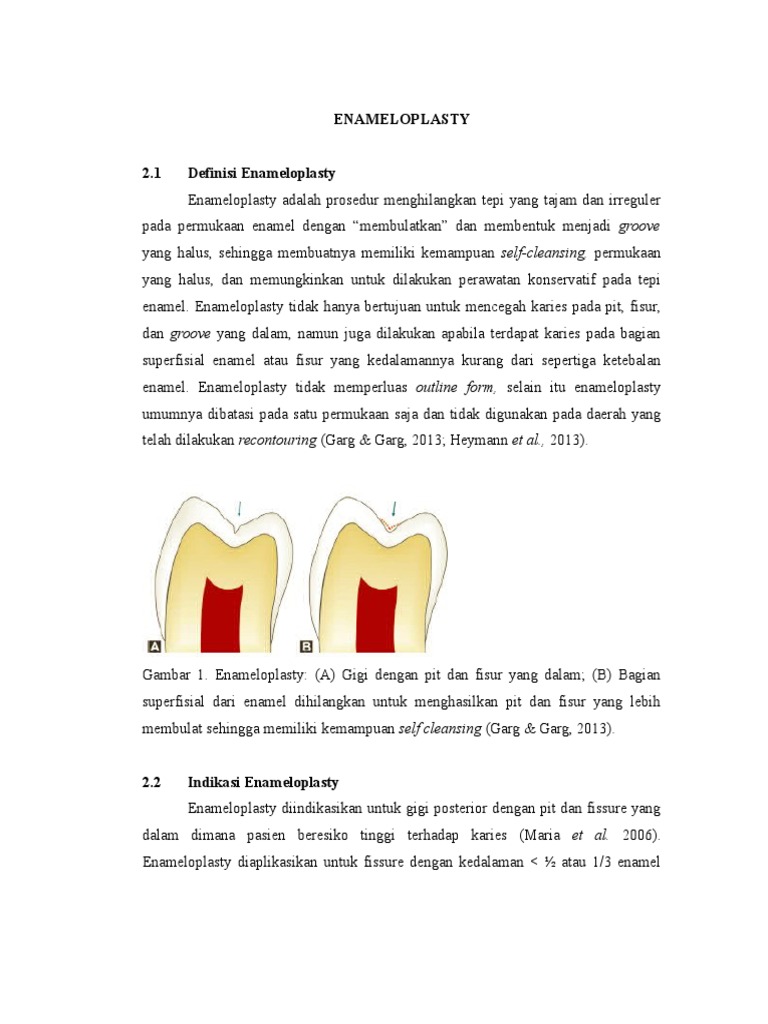 Enameloplasty Gabung | PDF