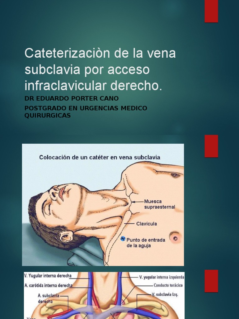 Cateterizaciòn de La Vena Subclavia Por Acceso Infraclavicular | PDF