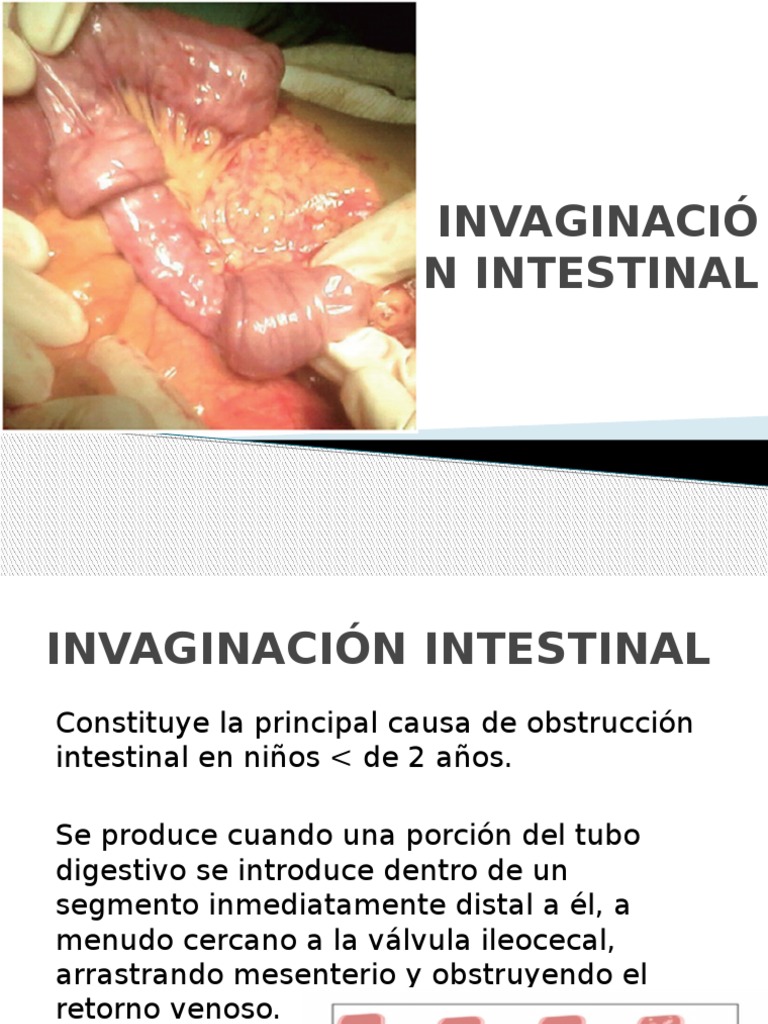 Invaginación Intestinal | PDF | Sistema digestivo humano ...