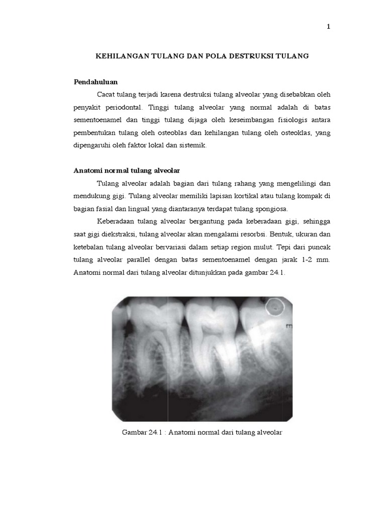 Destruksi Tulang Alveolar pada Periodontitis | PDF | Olahraga ...