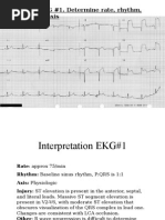 ICU One Pager External Pacemakers v11 | PDF | Artificial Cardiac ...