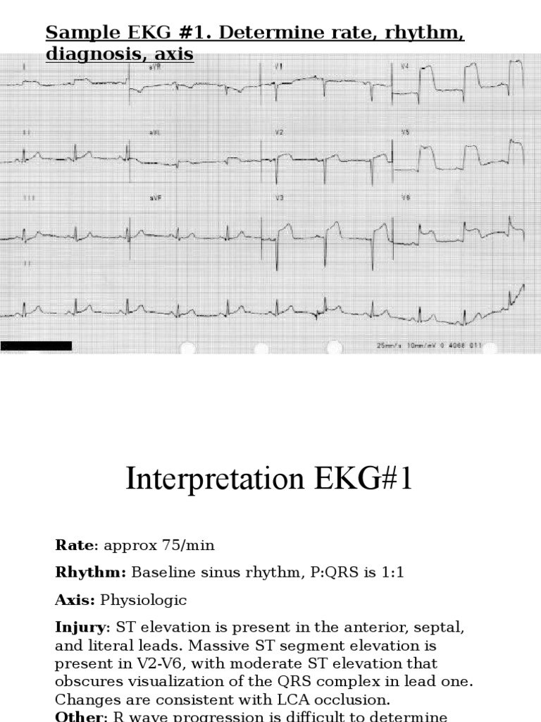 EKG Interpretation and Analysis Guide | PDF | Electrocardiography ...