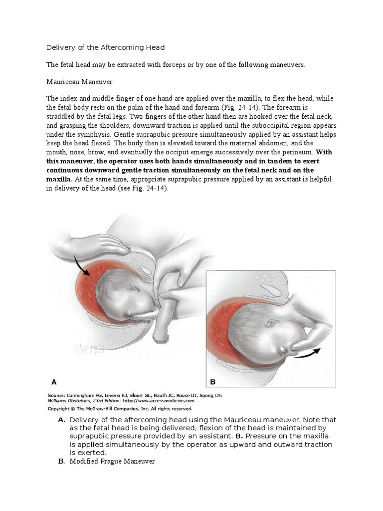 Maneuvers for Aftercoming Head Delivery | PDF | Anatomical Terms Of ...