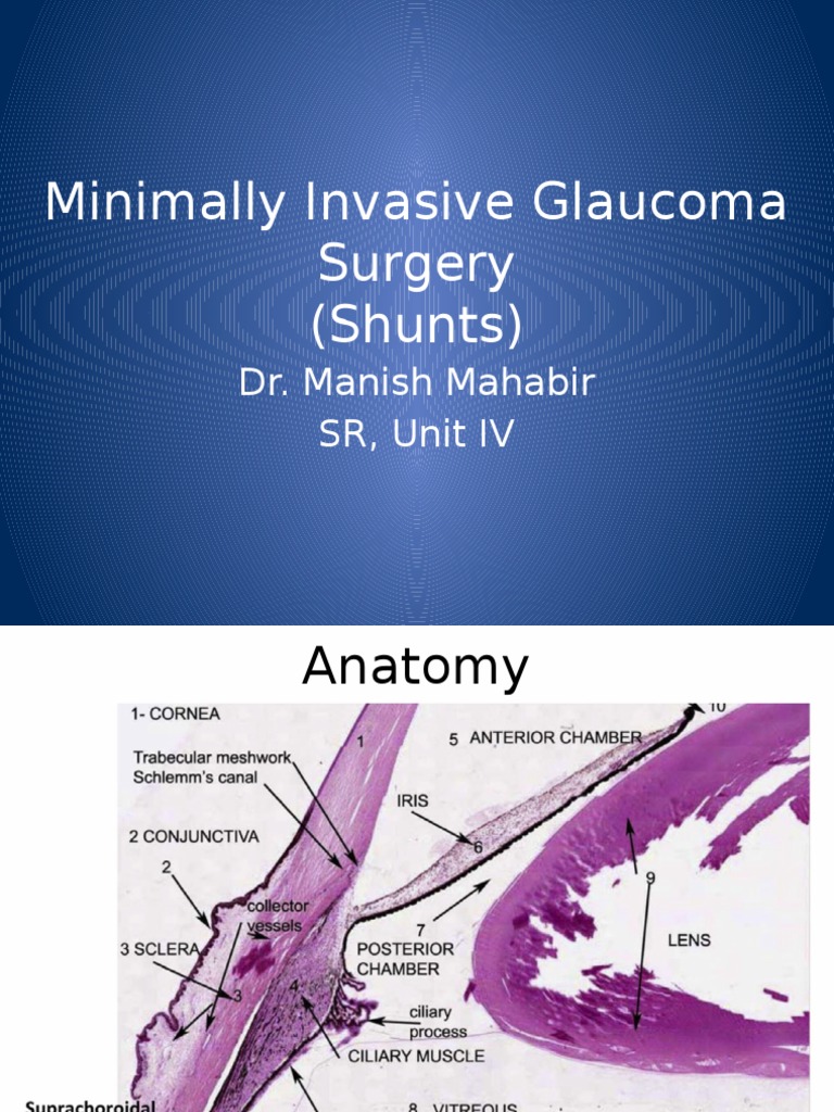 Minimally Invasive Glaucoma Surgery Overview | PDF | Vision | Medicine