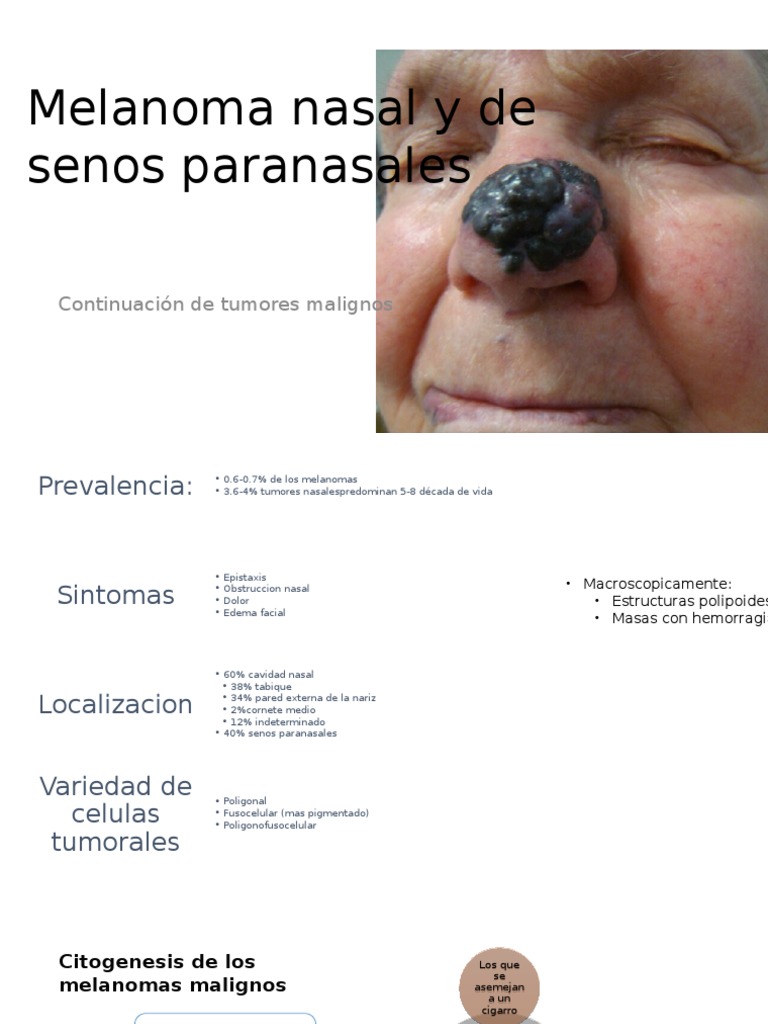 Cancer Nariz | PDF | Metástasis | Pecho