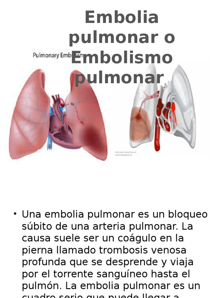Embolia Pulmonar | PDF | Embolia | Trombo