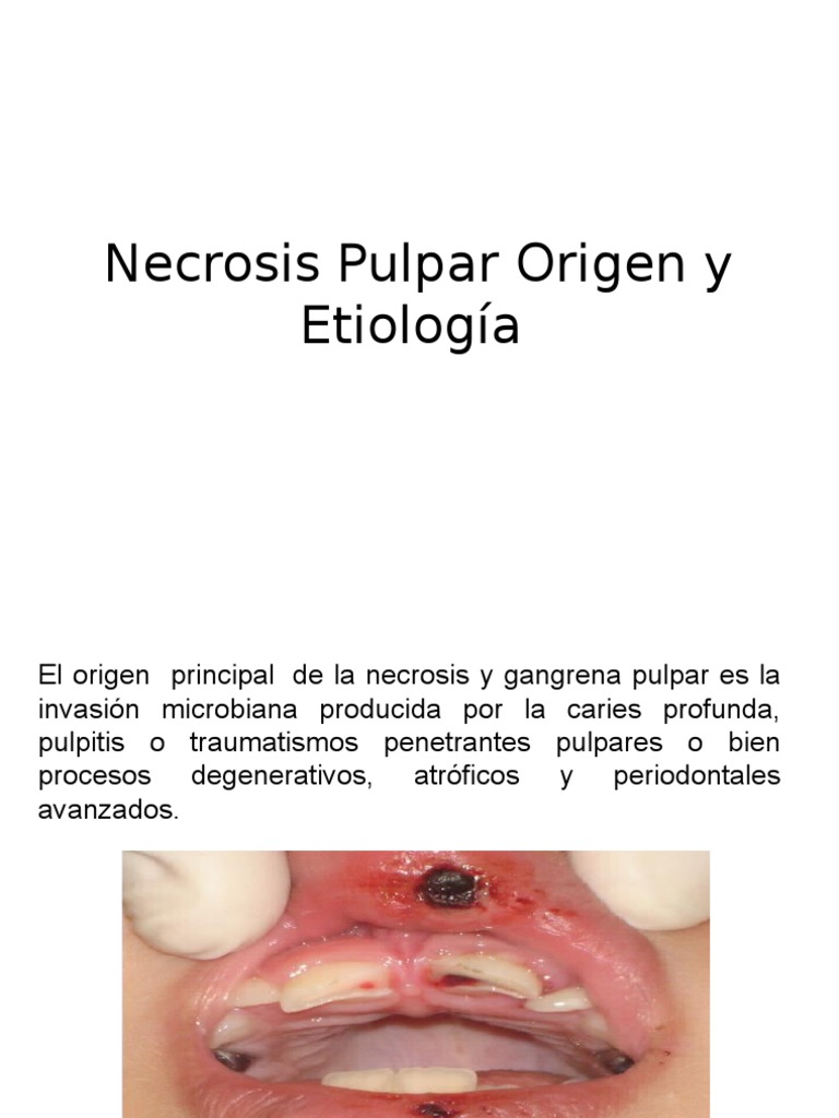 Necrosis Pulpar Origen y Etiología. | PDF