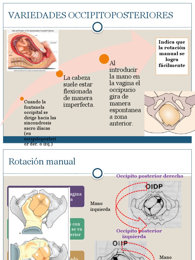 Occipito posterior persistente | Pelvis | Parto
