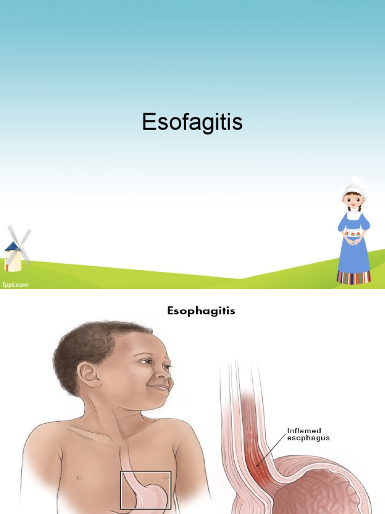 Esofagitis | PDF | Pengembangan Diri