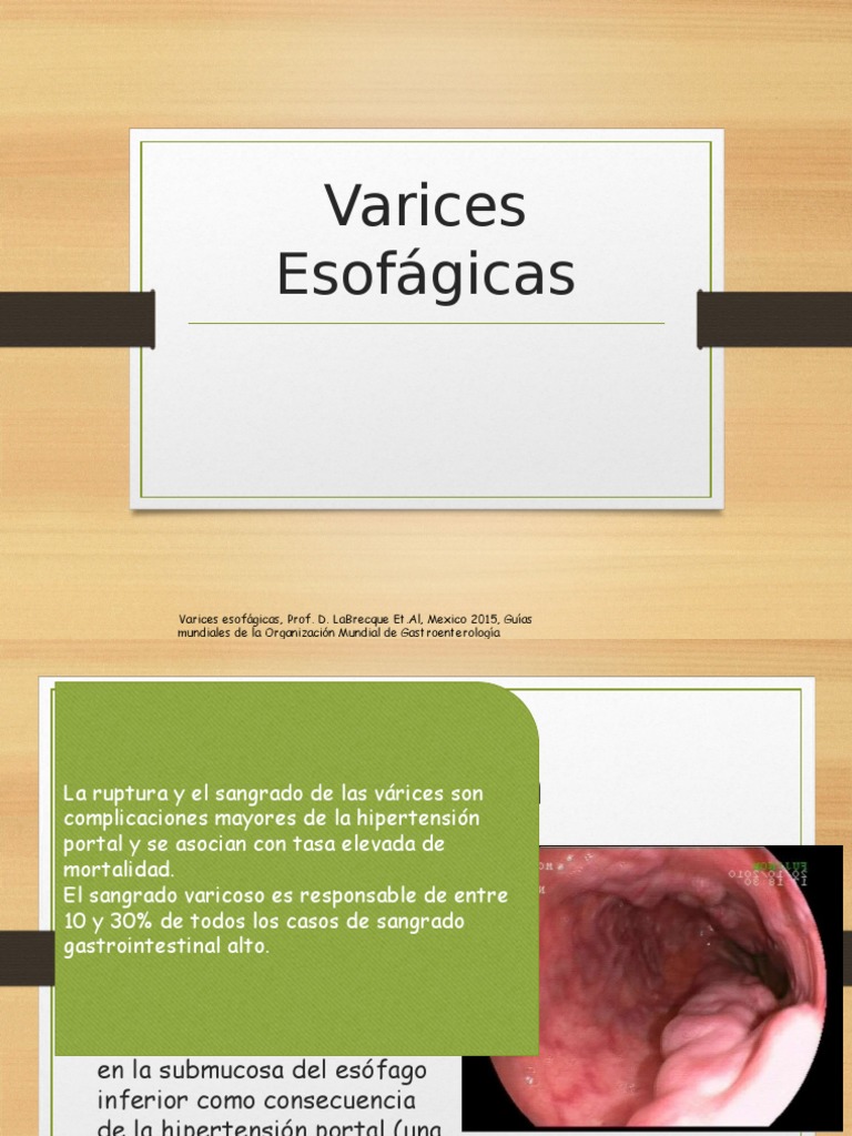 Várices Esofágicas: Diagnóstico y Riesgos | PDF | Venas varicosas ...