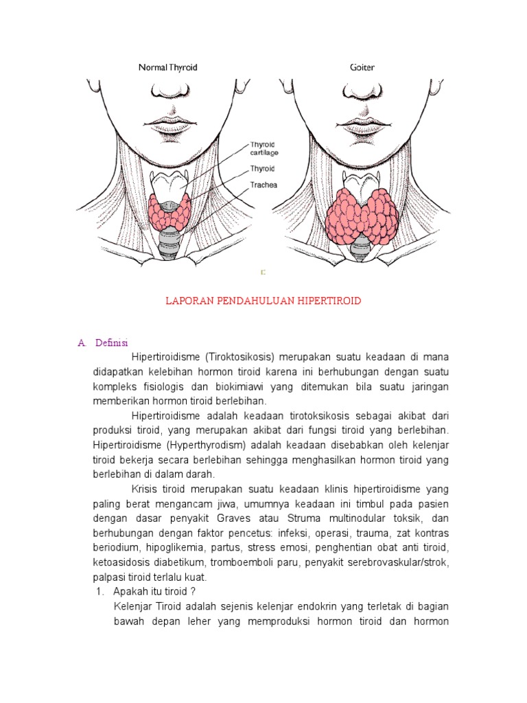 Hipertiroid | PDF