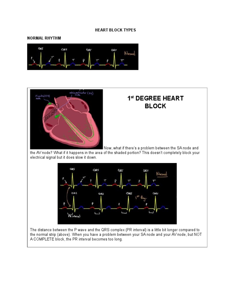Heart Block Types | PDF | Heart | Cardiac Electrophysiology