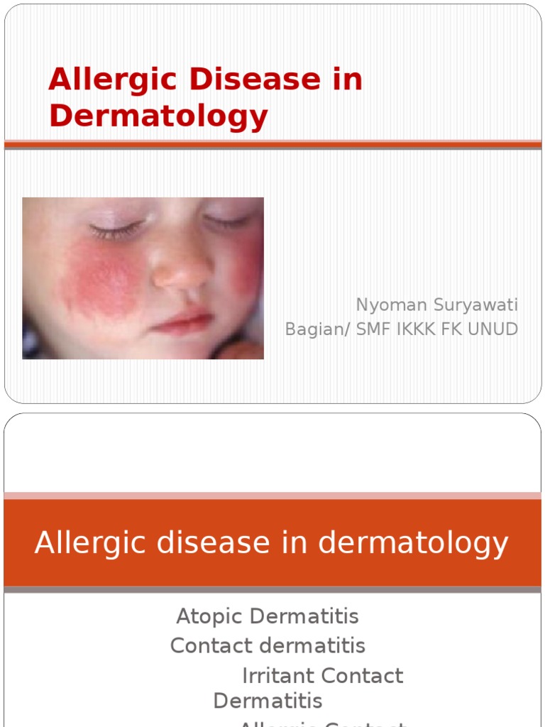 Dermatitis Pdf Dermatitis Allergy