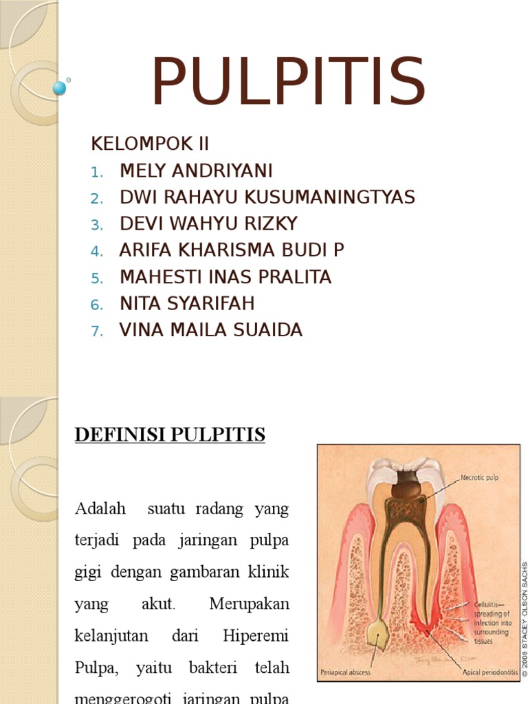 Pulpitis | PDF