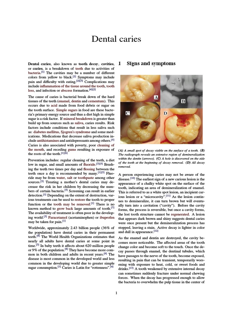 Dental Caries | PDF | Human Tooth | Tooth Enamel