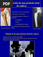 Protesis de Thompson Espanol SCECLE | PDF | Cirugía | Medicina CLINICA