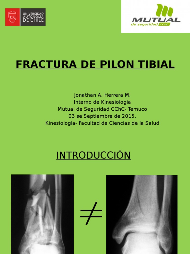 Fractura de Pilon Tibial Jonathan Herrera | PDF | Tobillo | Sistema musculoesquelético