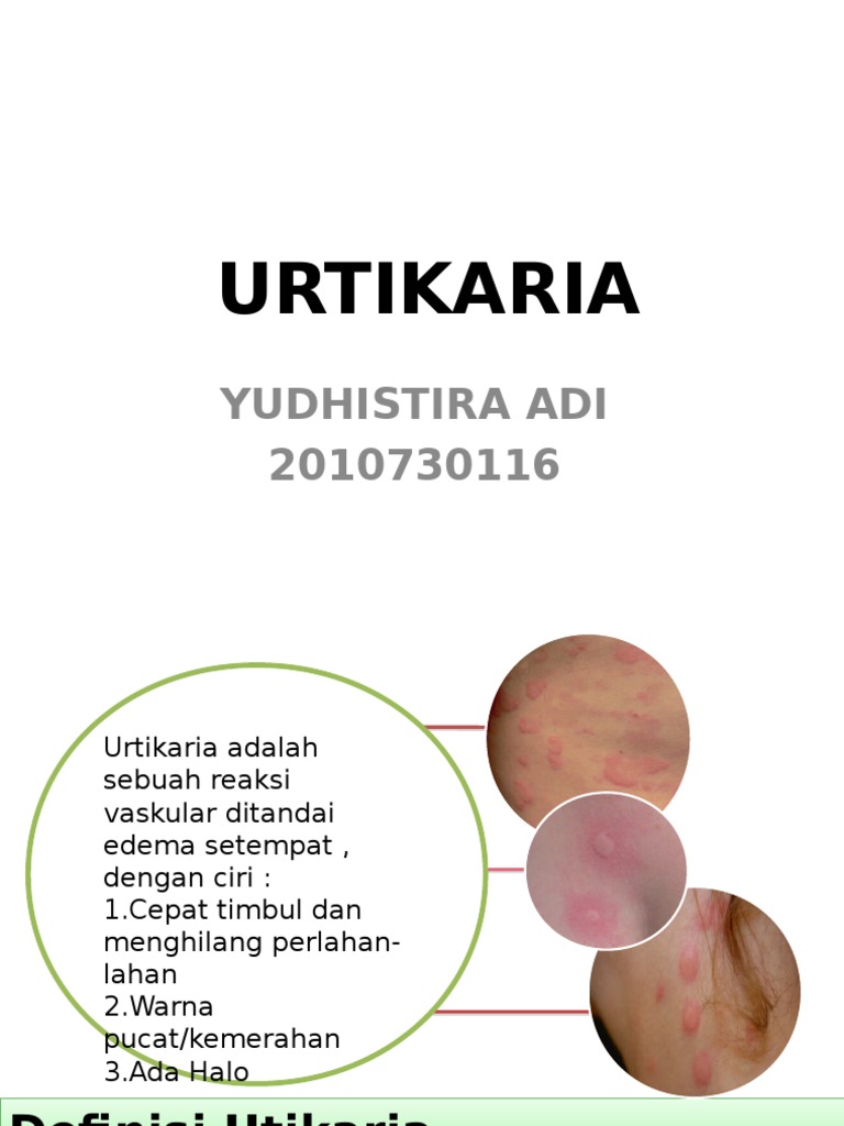 Urtikaria | PDF