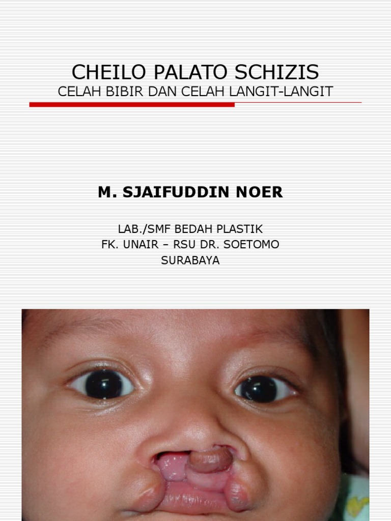 Cheilo Palato Schizis MSN | PDF | Seni & Disiplin Bahasa | Sains ...