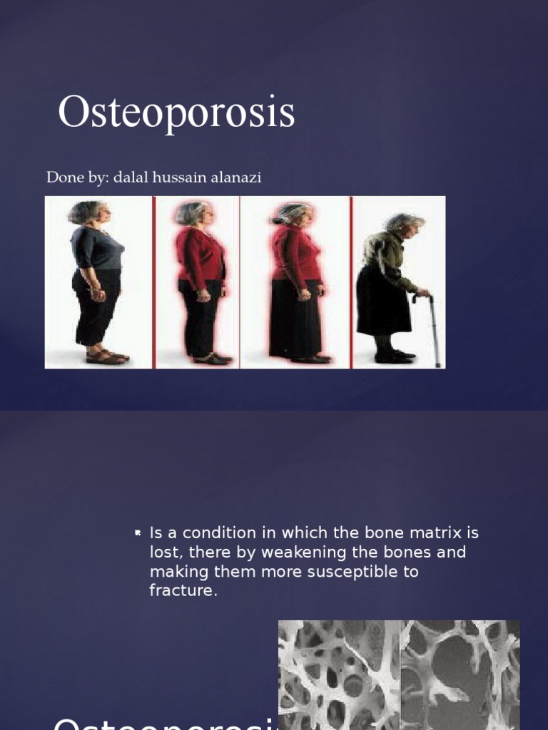 Osteoporosis: Done By: Dalal Hussain Alanazi | PDF | Osteoporosis | Bone