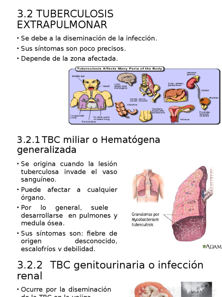 Tuberculosis Extrapulmonar | PDF