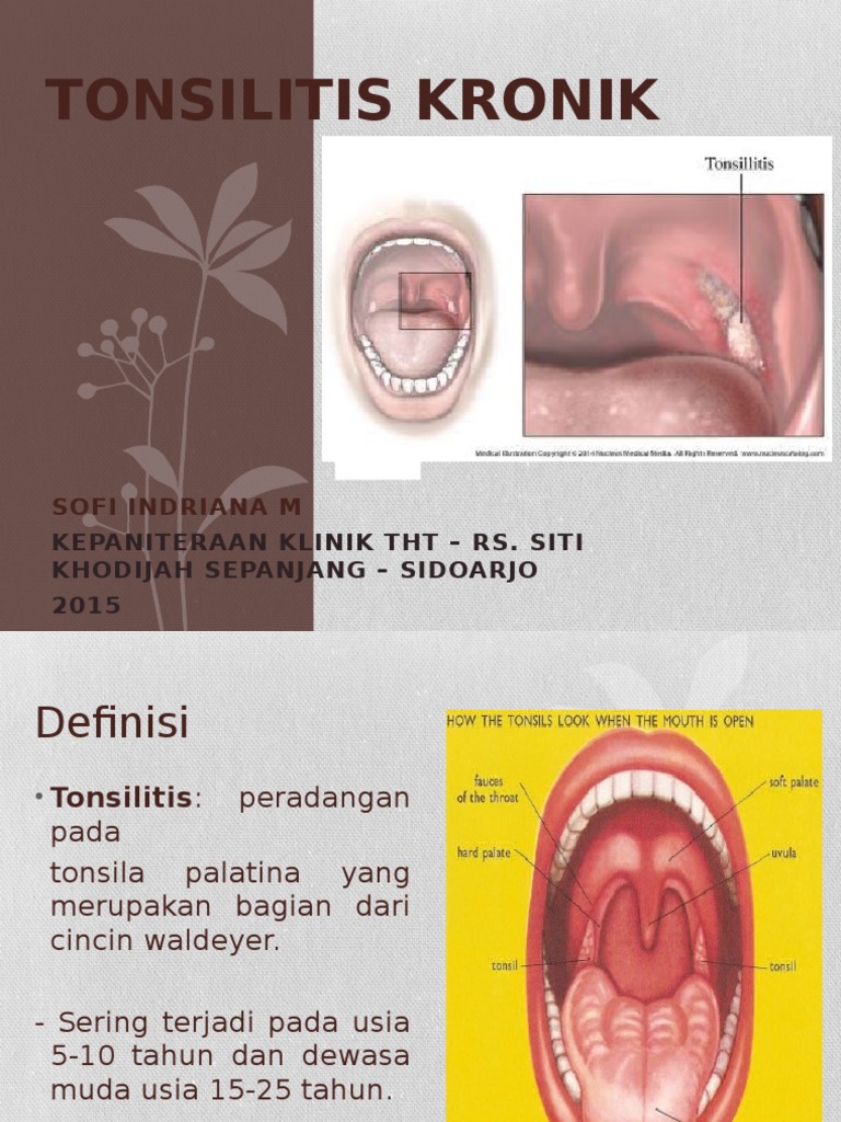 Tonsilitis Kronik | PDF